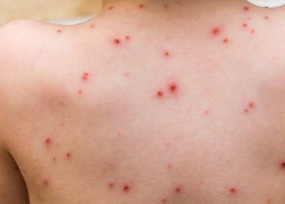 Strep Throat Rash On Legs Strep Throat Rash On Legs